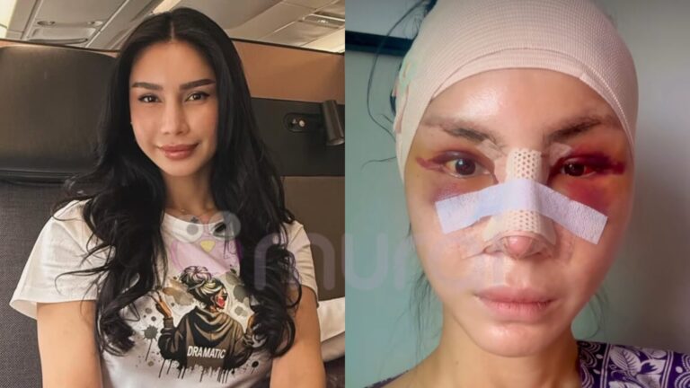 Sajat Kongsi Momen Buat Pembedahan Hidung, Undang Teguran Netizen ...